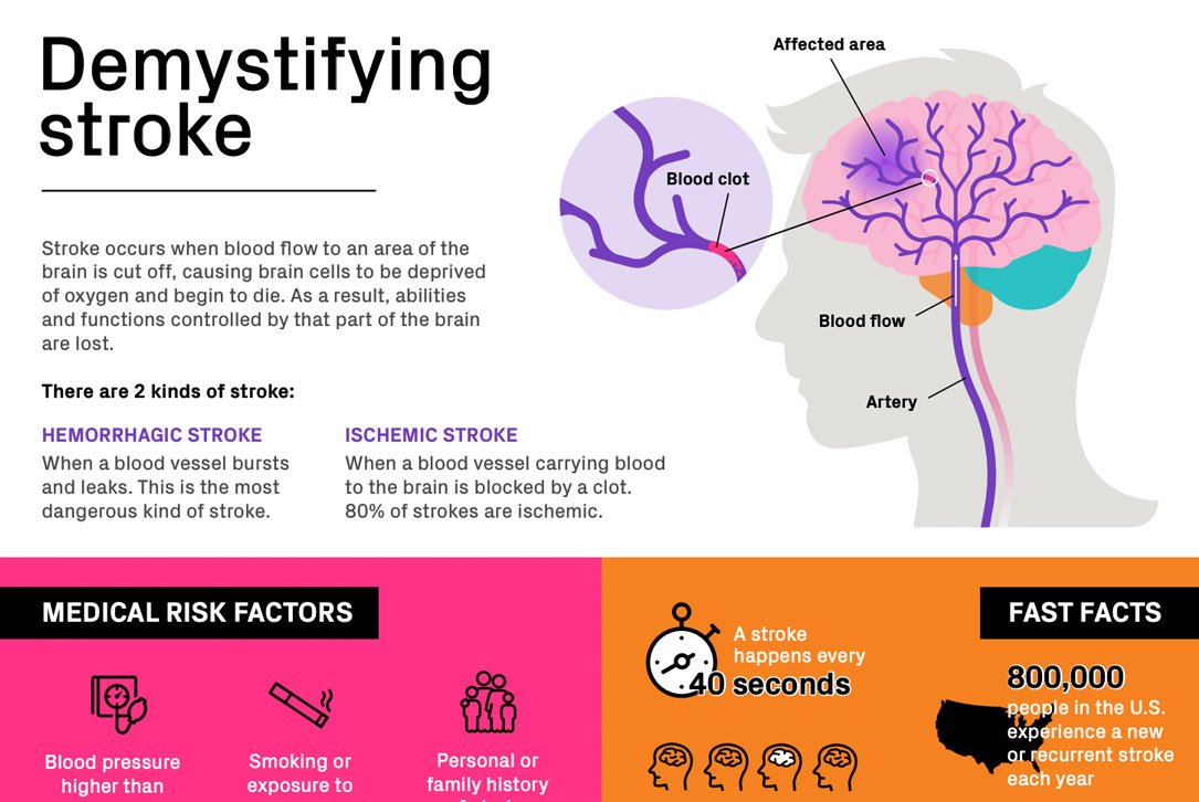 Download Demystifying Stroke: Signs and Symptoms Explained